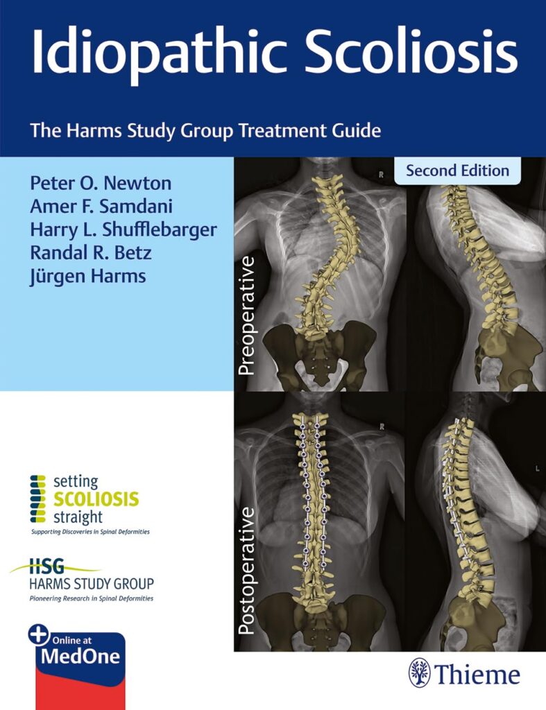 Idiopathic Scoliosis: The Harms Study Group Treatment Guide – Orthopedics